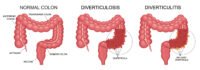 Understanding Diverticulitis Flare-Ups: Triggers and Remedies - Calming ...