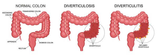 Understanding Diverticulitis Flare-Ups: Triggers and Remedies - Calming ...